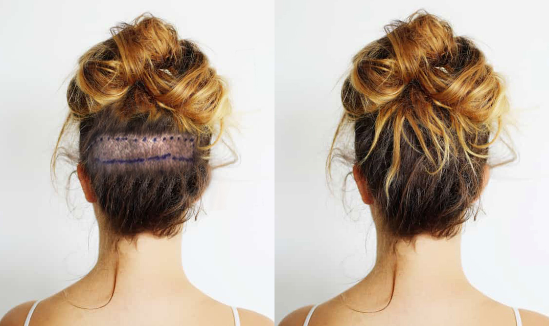 The Rise of Long-Hair FUE: Keeping Your Donor Locks Intact - Informed ...